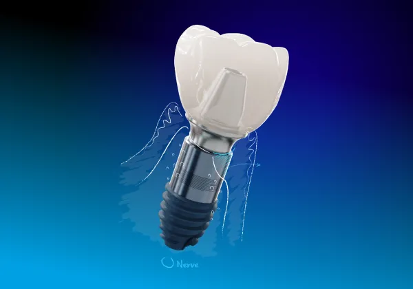 Special Solution for Molar Defects