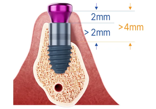 Prevention of Peri-Implantitis