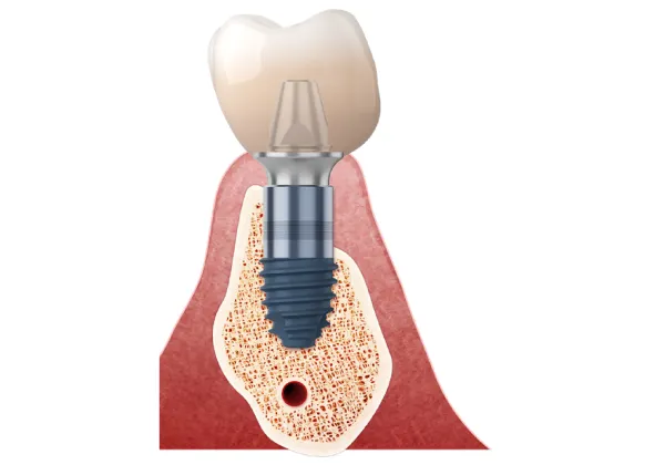 Fast and Easy Placement