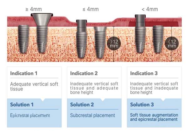 Zero Bone Loss Concept